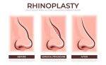 How to Straighten Your Nose Without Surgery